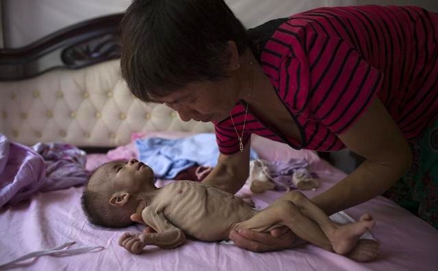 Chinese Baby with Rare Growth Disorder May Suffer from Costello ...